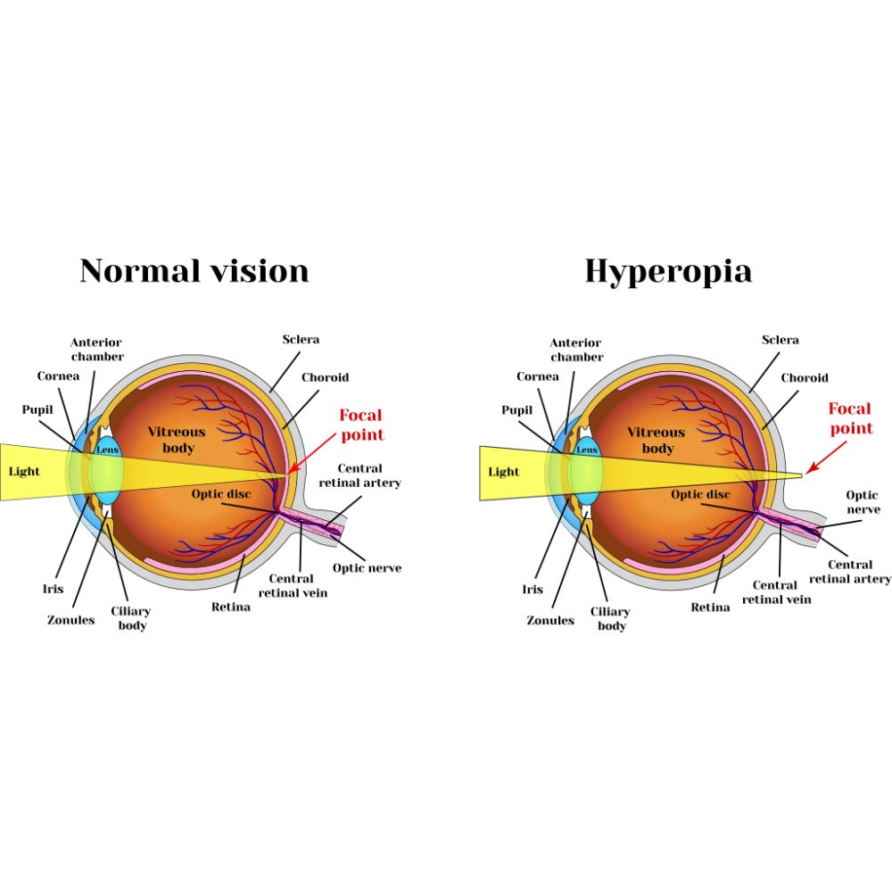 Hyperopia - Heyes Opticians